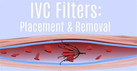Ivc Filter