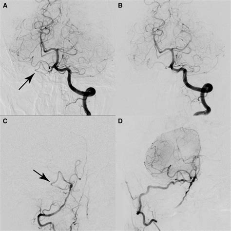 Preoperative Injection From The Left Va A And Right Dca C And