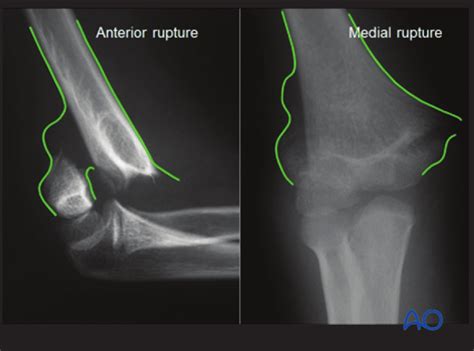 Closed Reduction Of Supracondylar Fractures