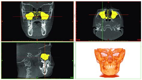 Maxillary Sinus