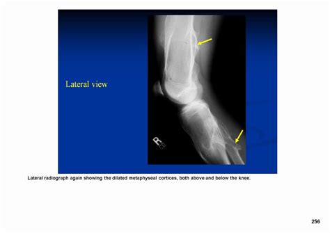 Multiple Hereditary Exostosis An Atlas Of Musculoskeletal Oncology