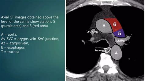 Radiological Anatomy Of Thoracic Lymph Nodes Pptx