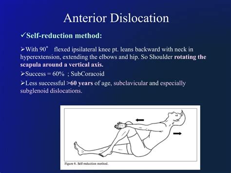 Ppt Shoulder Dislocation Powerpoint Presentation Id 4841498