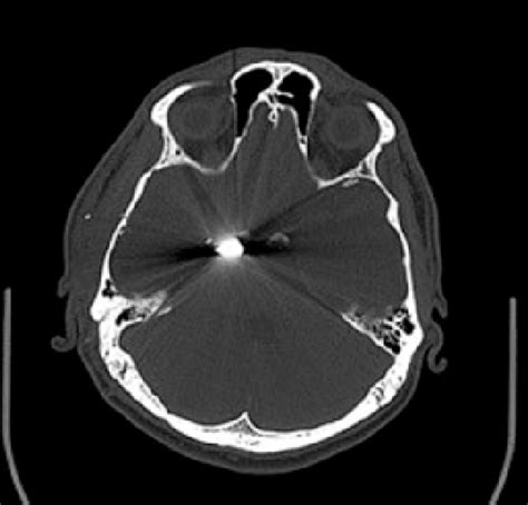 Metallic Artifact Of The Shrapnel In Computed Tomography Download