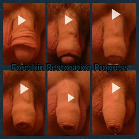 Foreskin Restoration Before After