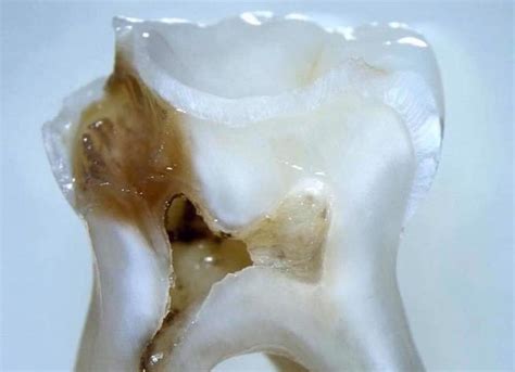 ШҮД Хэрэв таньд цоорсон шүд байгаа бол тэр цоорол нь Facebook