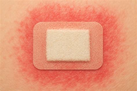 Understanding The Symptoms And Codes Of Adhesive Tape Allergy Icd 10 Tapes