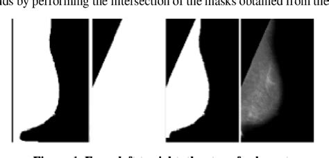 Figure 1 From Breast Lesion Detection From Mammograms Using Deep Convolutional Neural Networks