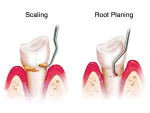 Dental Scaling And Root Planing The Smile Gallery