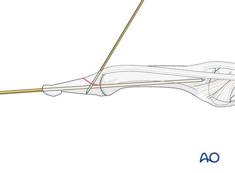 Extensor Block Pinning Or K Wire Fixation With Joint Transfixation