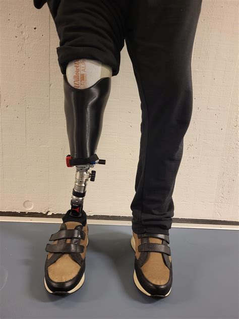 Transtibial Prosthetic Socket Design Using Artificial Intelligence Ai