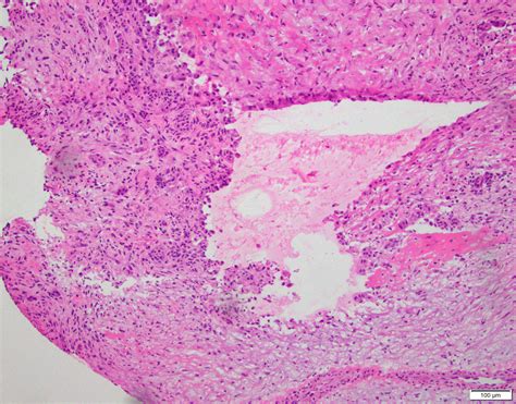 Pathology Outlines Aneurysmal Bone Cyst Pathology Outlines Aneurysmal Bone Cyst