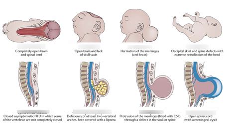 Exam 2 Neural Tube Defects Diagram Diagram Quizlet