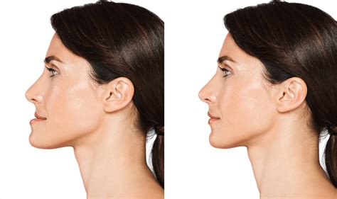 Protruding Chin Surgical Before And After Simulator
