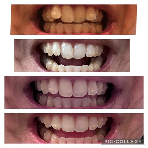 7 Months In 1621 Trays Rinvisalign