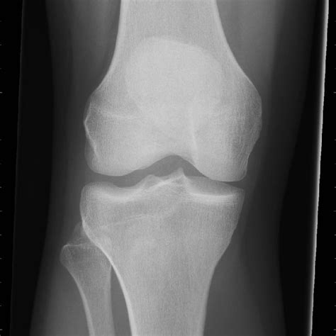 The Skyline Projection Of The Right Knee Does Not Reveal A Patellar
