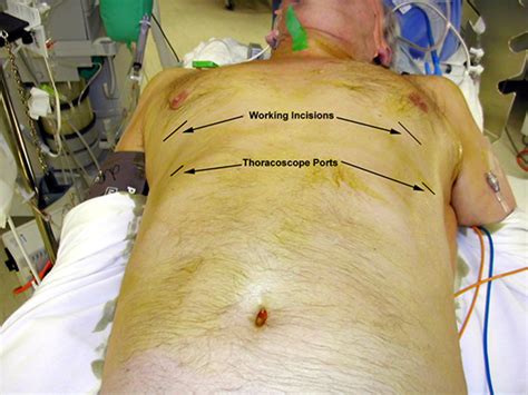 Thoracoscopic Management Of Spontaneous Pneumothorax Ctsnet