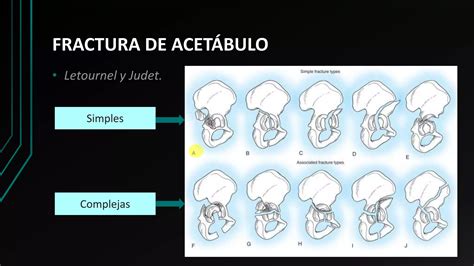 Fractura De Pelvis Y Acetabulo