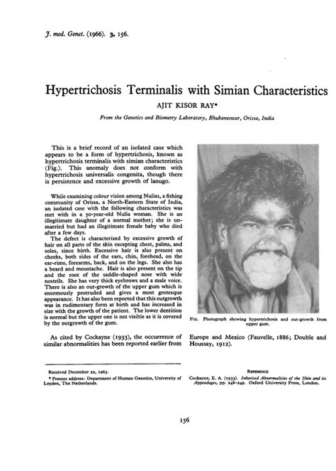 Hypertrichosis Terminalis With Simian Characteristics Journal Of Medical Genetics