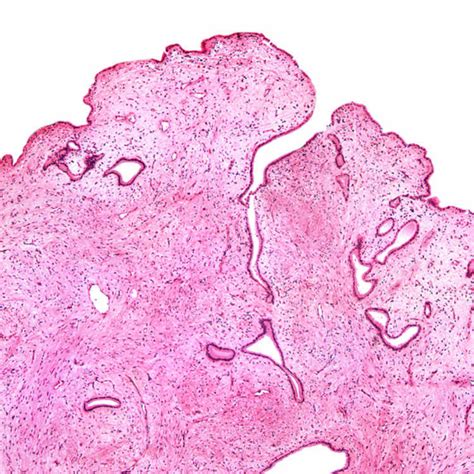Inflammatory Polyps Basicmedical Key