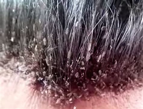 The Man With The Worlds Worst Head Lice Infestation Is Living An