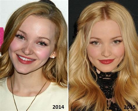 Dove Cameron Before And After Plastic Surgery Nose Lips Boob