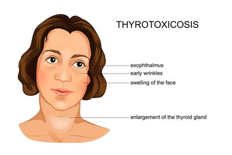Thyrotoxicosis Vector Art Stock Images Depositphotos