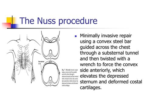Ppt Pectus Excavatum Pe Powerpoint Presentation Free Download Id