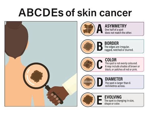 Skin Cancer Among Women With An Inherited Brca Mutation