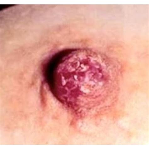 Clinical Features Of Mpd A Nac With Significant Erythema Scaling Download Scientific