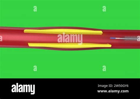 Balloon Angioplasty Procedure Stock Videos And Footage Hd And 4k Video