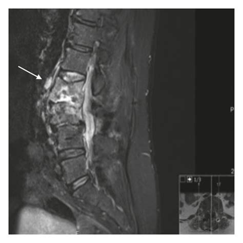 Case 2 Sagittal T2 Weighted Image Showing Lytic Lesions At L2 And L3