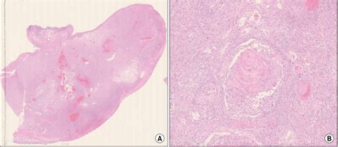 Pathologic Findings Of The Tumor A The Polypoid Lesion Showed