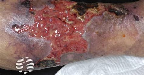 Calciphylaxis Image