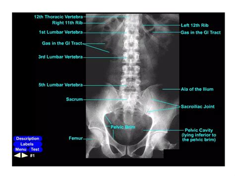 Abdomen Radiography Ppt