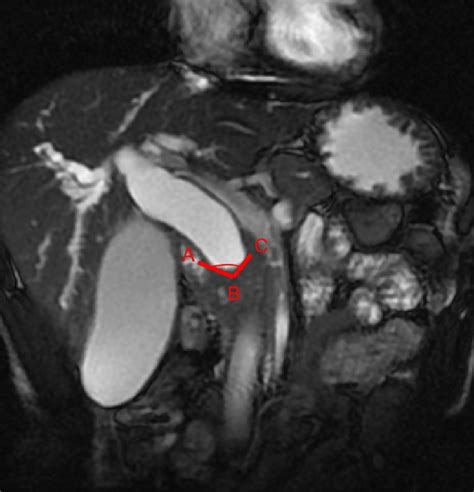 Mrcp Combined With Ct Promotes The Differentiation Of Benign And