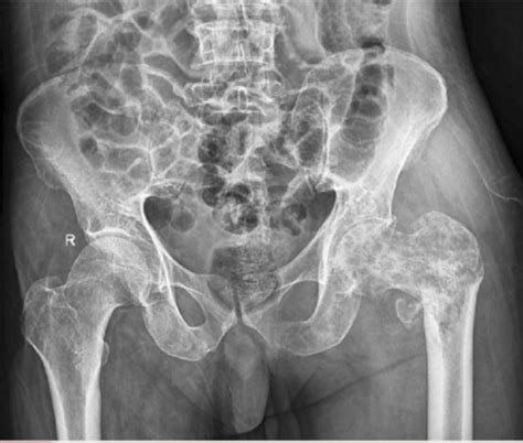 Pathology For Pelvis Flashcards Quizlet