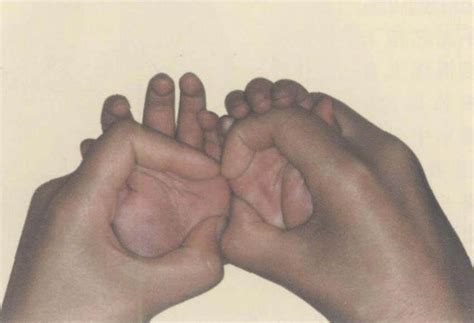 头痛 掌纹诊病实例分析