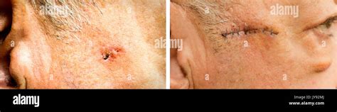 Basal Cell Carcinoma Forehead