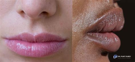 Lip Reduction Surgery In Delhi Lip Reduction Surgery Cost In Delhi