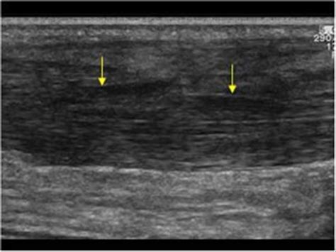 Musculoskeletal Joints And Tendons 67 Ankle Case 672 Achilles