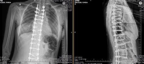 Skolyoz Nedir Skolyoz Tedavisi Prof Dr Oğuz Cebesoy