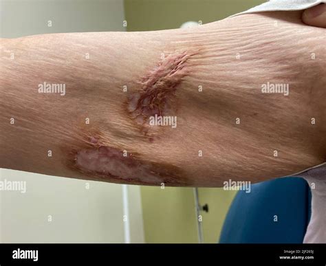 Pyoderma Gangrenosum This Disease Causes Painful Ulcers On The Skin