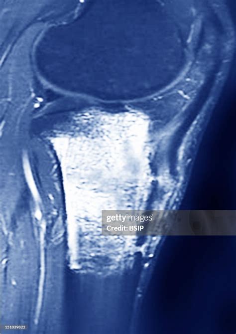 Osteosarcoma Of The Upper Part Of The Tibia Mri Of A Lateral View Of