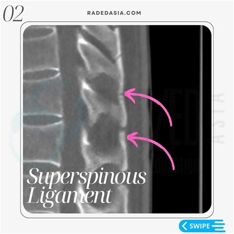 Ankylosing Spondylitis Spine Radiology Ct Mri Fusion Images Radiology