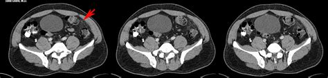 Roentgen Ray Reader Epiploic Appendagitis
