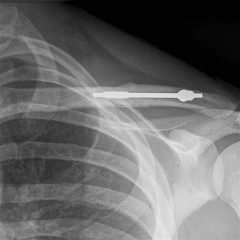 Fracture Displacement And Shortening Download Scientific Diagram