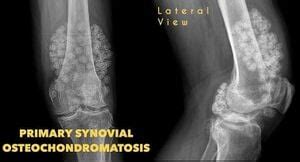 Synovial Osteochondromatosis Wikism Sports Medicine Wiki