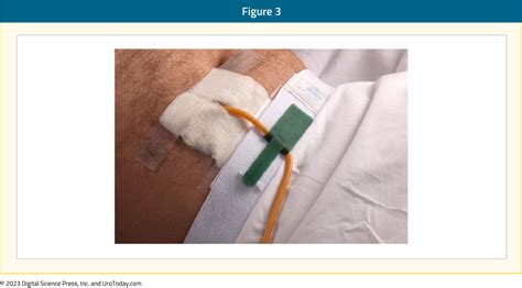 Pouching A Suprapubic Catheter Indwelling Transurethral And