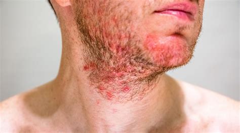 Itchy Beard What Causes It And How To Stop It Hair World Magazine